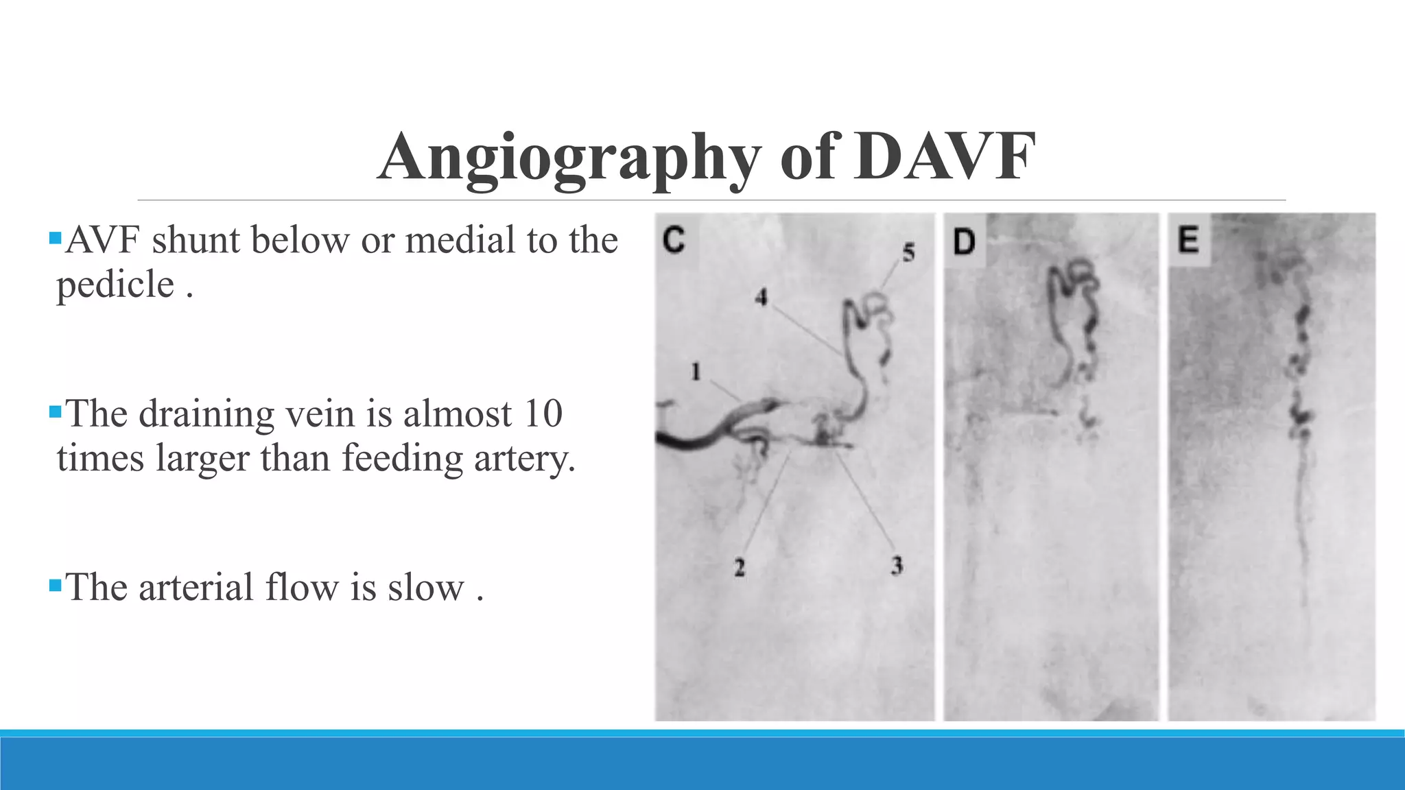 spinal angiography with spnal av anomalies | PPTX