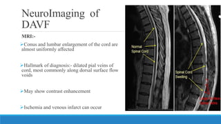 spinal angiography with spnal av anomalies | PPT