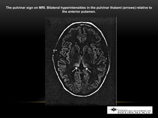 Prion diseases | PPTX