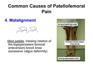 Mystery of Knee pain Black Hole of Orthopedics- Patellofemoral joint dr ...