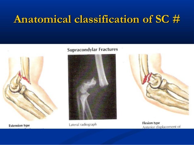 supracondylar fracrture of humerus in children