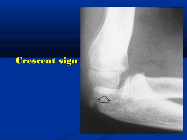 supracondylar fracrture of humerus in children