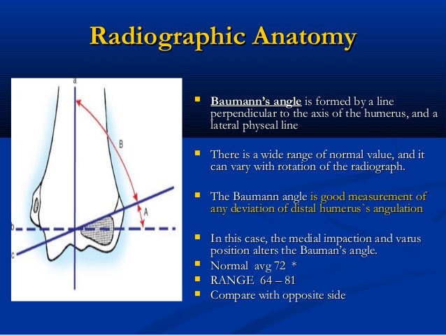 supracondylar fracture humerus in children