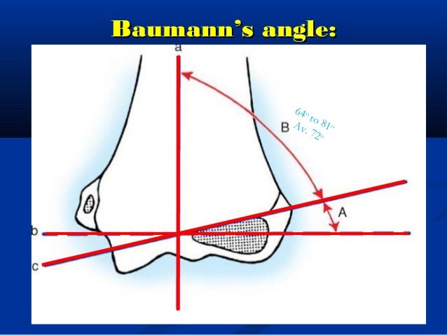supracondylar fracture humerus in children