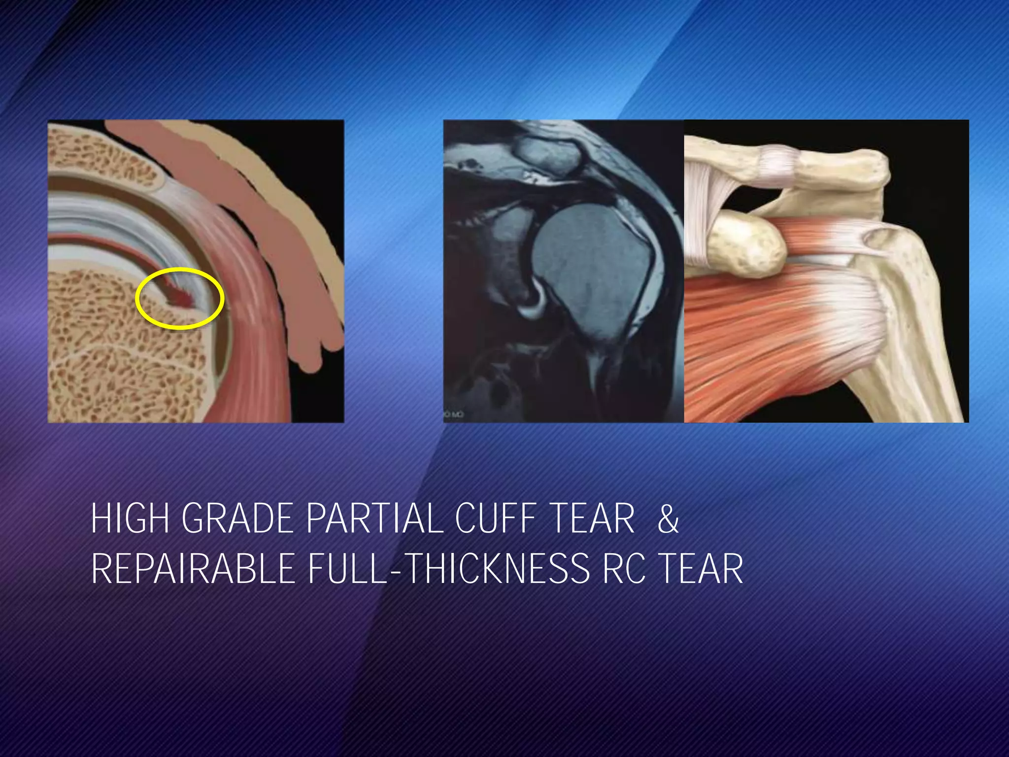 My Techniques for Shoulder Joint Preservation | PDF