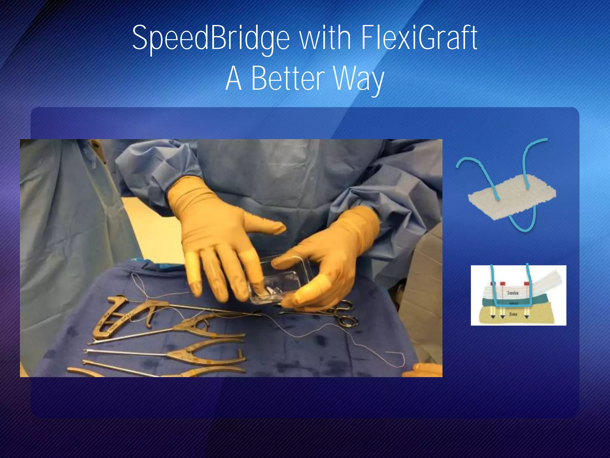My Techniques for Shoulder Joint Preservation | PDF
