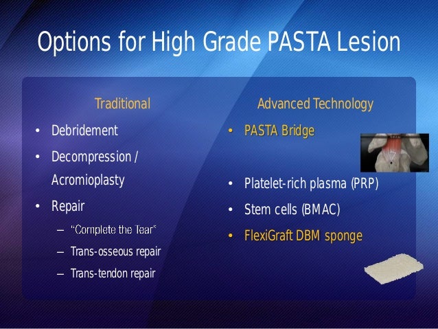 Pasta Lesion Repair Cpt _ Pasta Bridge Treatment – OVNI
