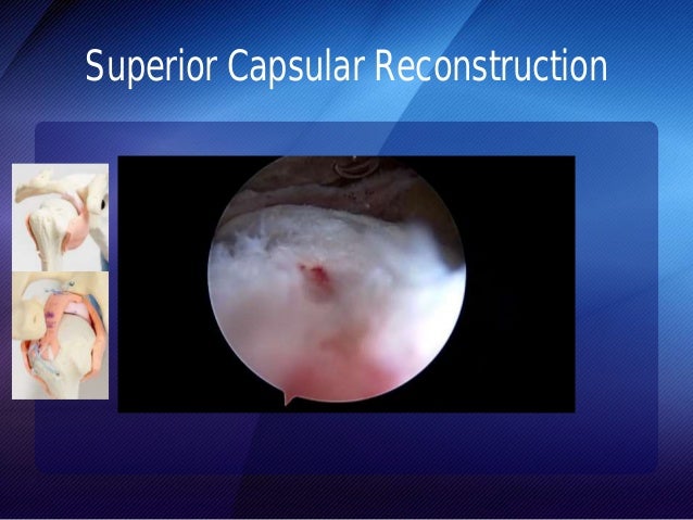 Shoulder superior capsular reconstruction - lasopaju