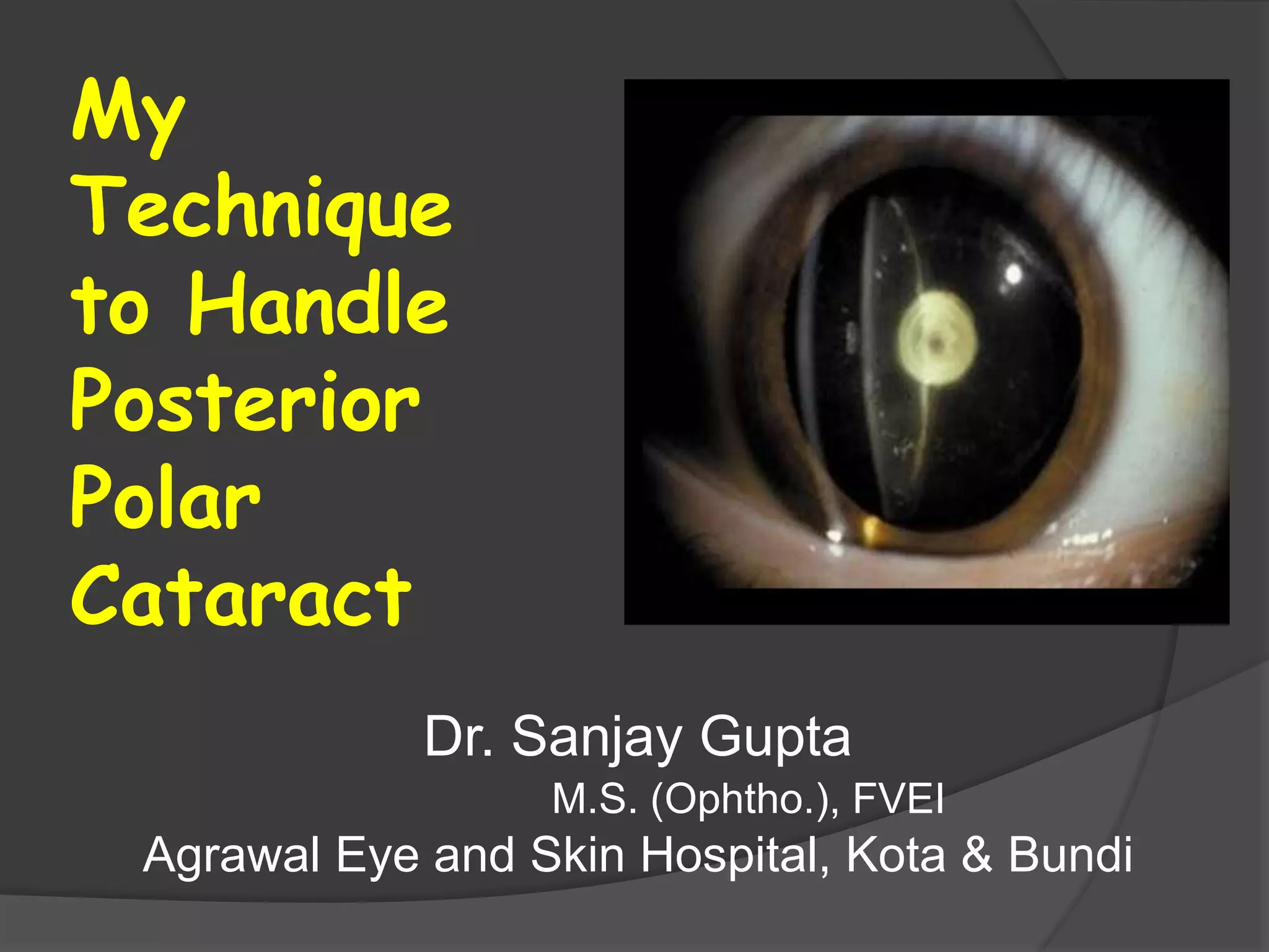 My technique to handle posterior polar cataract | PPTX