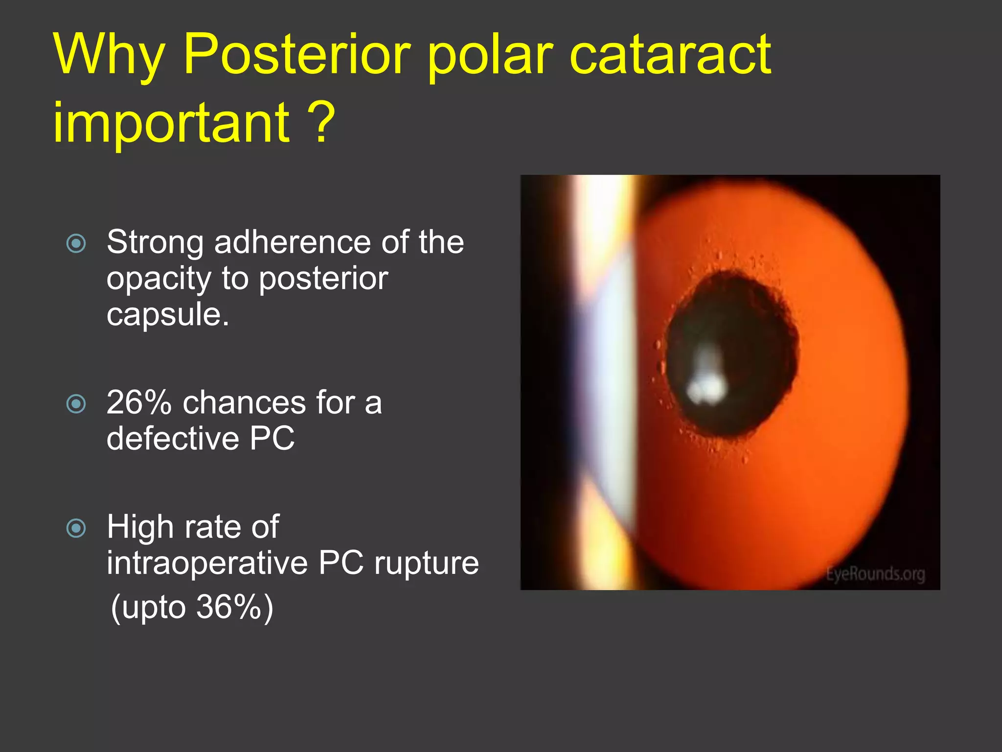 My technique to handle posterior polar cataract | PPTX