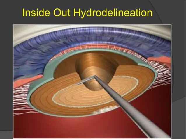My technique to handle posterior polar cataract | PPT
