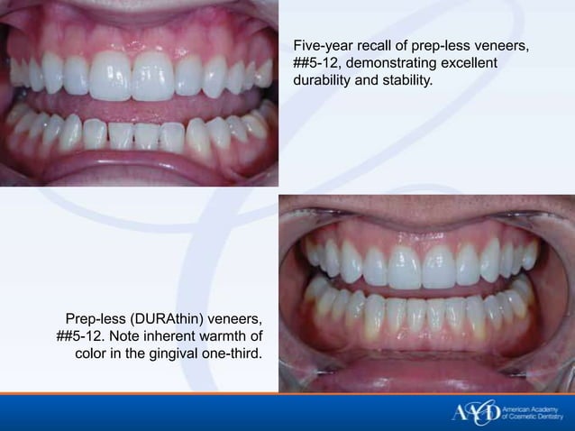Two Viewpoints: Prepared and Minimal Prep Veneers | PPTX