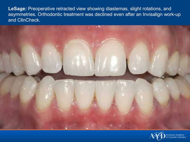Two Viewpoints: Prepared and Minimal Prep Veneers | PPTX