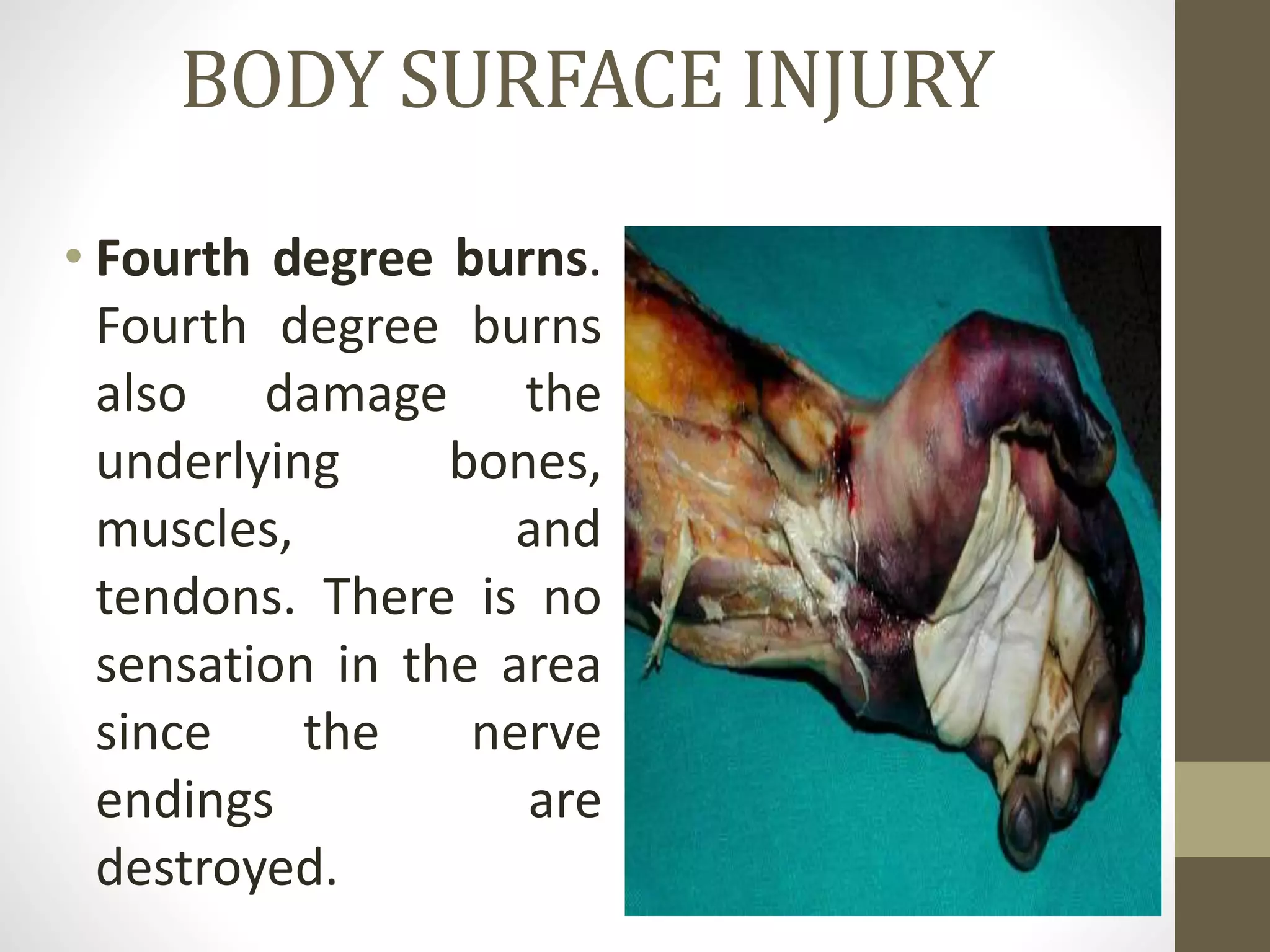 BURN - Presented By Mohammed Haroon Rashid | PPTX