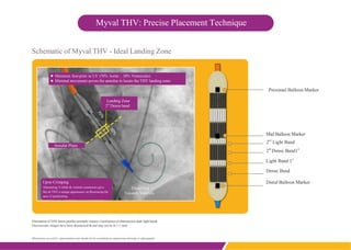 Myval THV Transcatheter Heart Valve by Meril Life | PDF