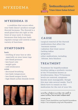 Symptoms, Causes, Treatment of Myxedema | PDF
