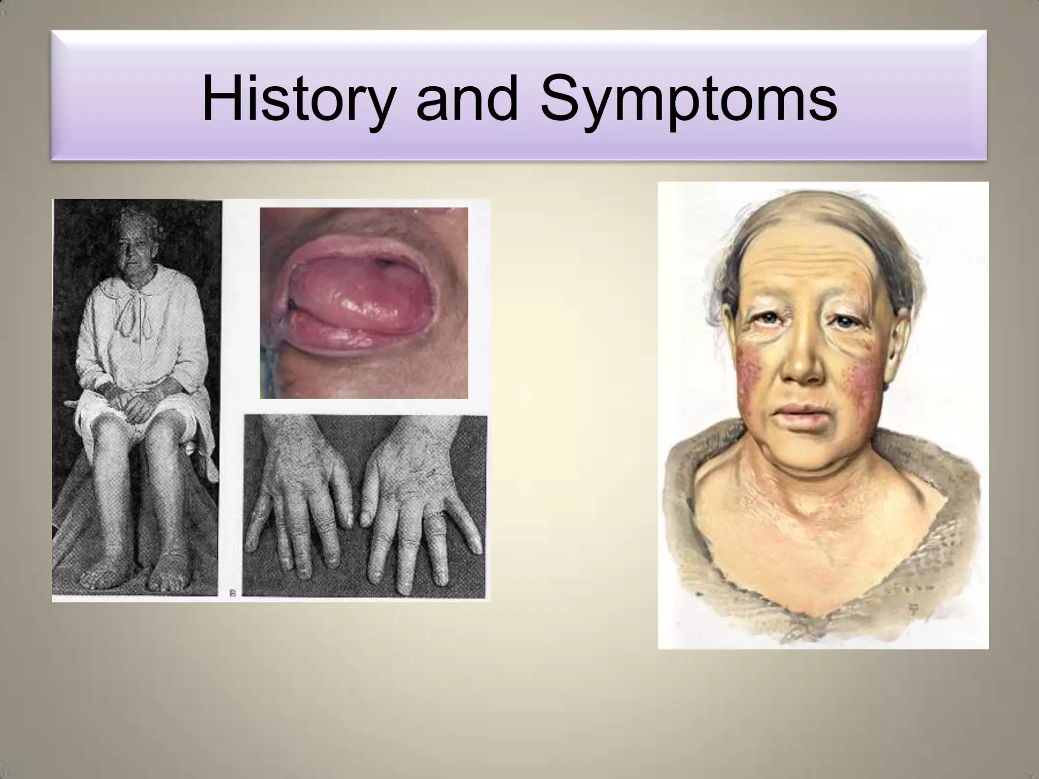 Myxedema & hypothyroid | PPTX