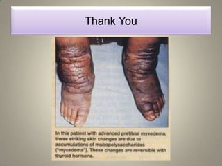 Myxedema & hypothyroid | PPTX
