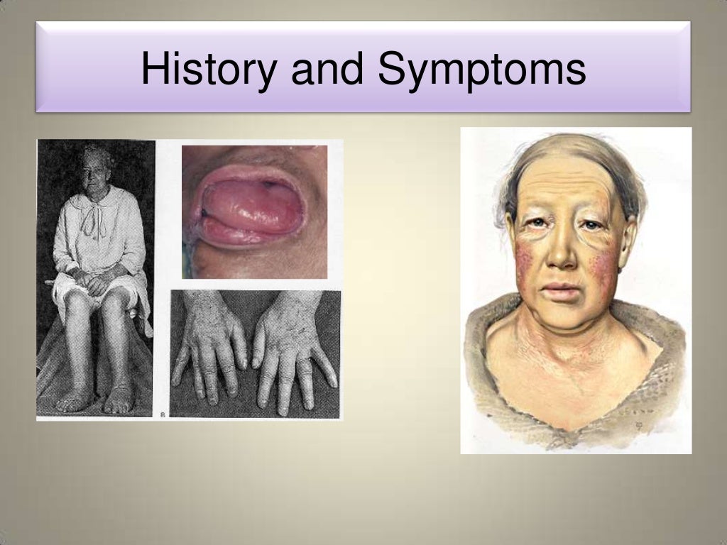 Myxedema & hypothyroid