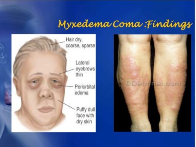 Myxedema coma | PPT