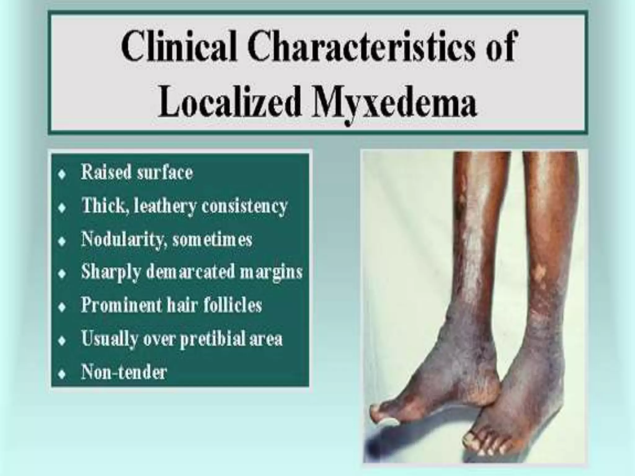 Myxoedema | PPTX | Thyroid Disorders | Endocrine and Metabolic Diseases