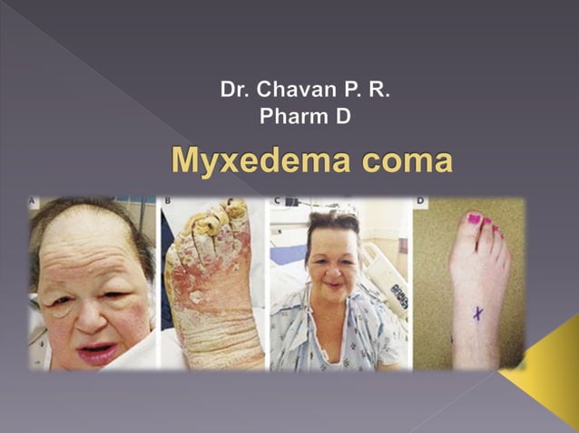 Myxoedema coma Pharmacotherapeutic view | PPTX