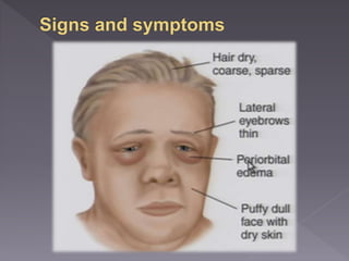 Myxoedema coma Pharmacotherapeutic view | PPTX