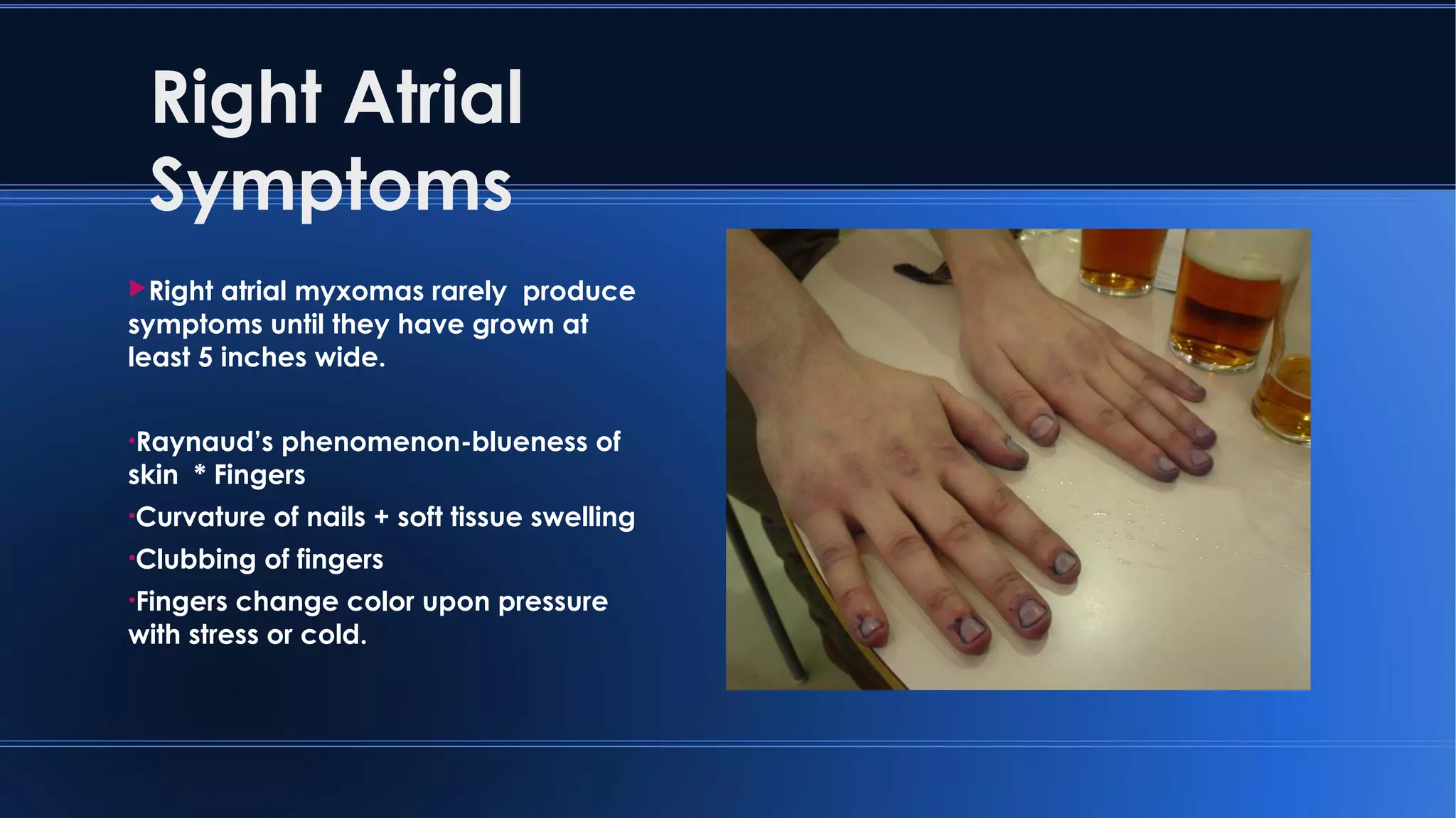 Myxoma powerpoint | ODP
