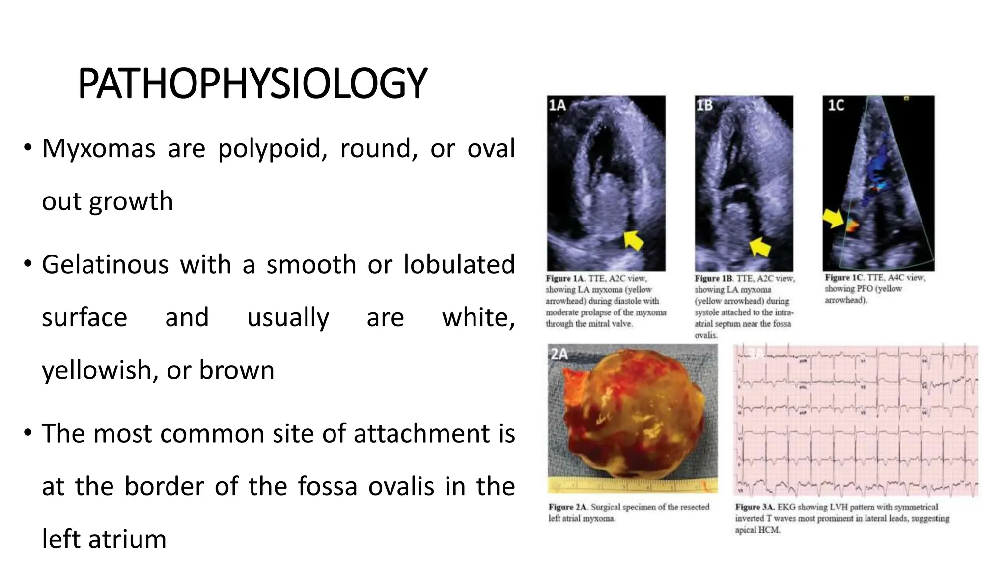 PHYSIOTHERAPY MANAGEMENT IN POST ATRIAL MYXOMA EXCISION | PPTX