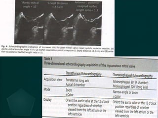 MVP Mitral Valve Prolapse - Echocardiographic Evaluation | PPTX