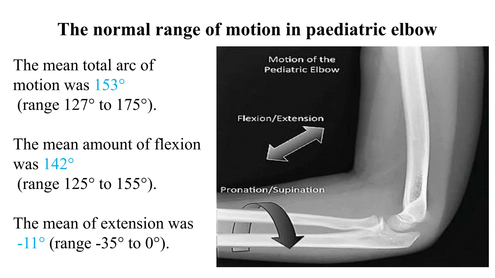 Pediatric Supracondylar humerus fracture .pptx
