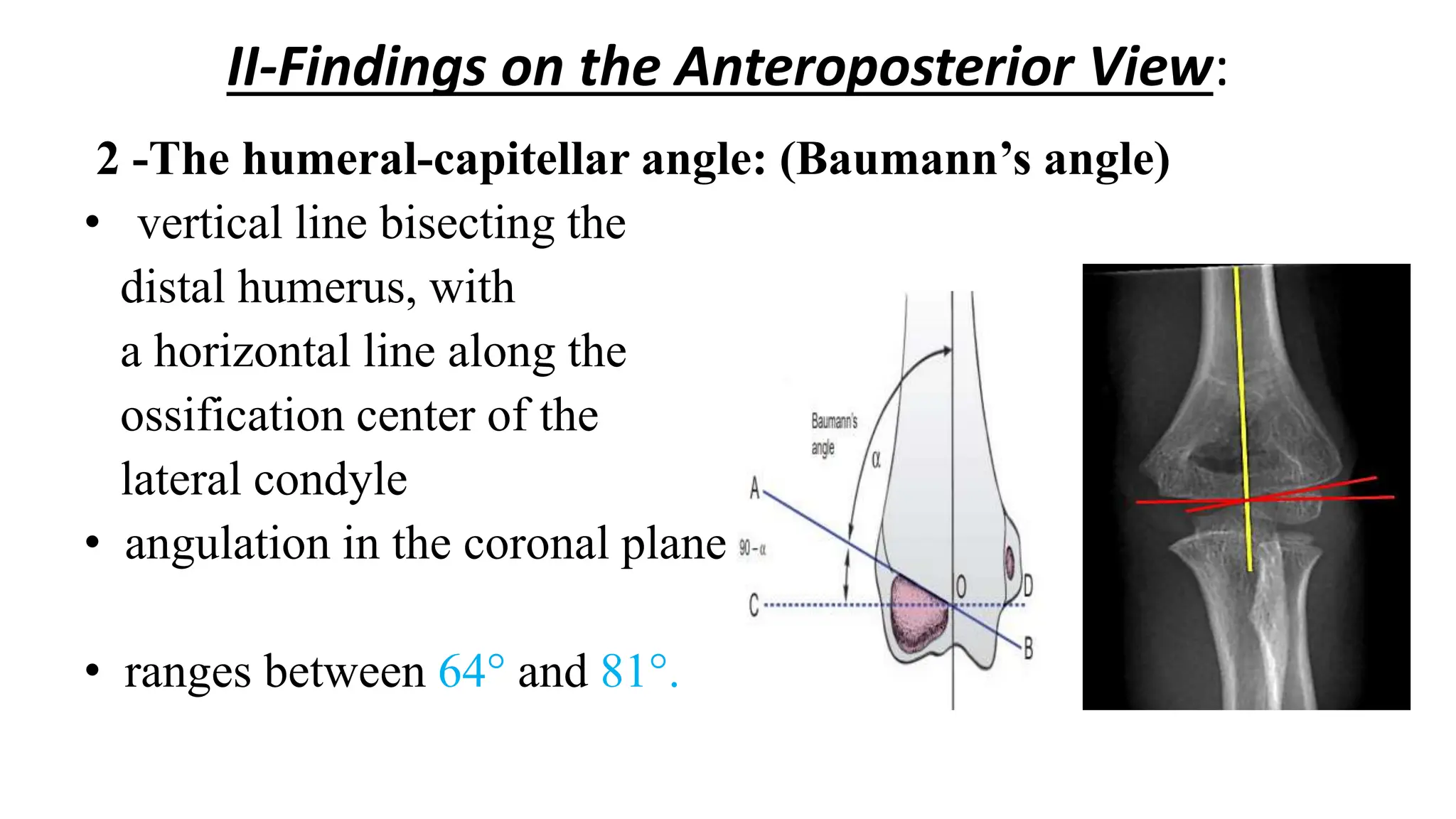 Pediatric Supracondylar humerus fracture .pptx