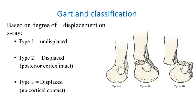 Pediatric Supracondylar humerus fracture .pptx