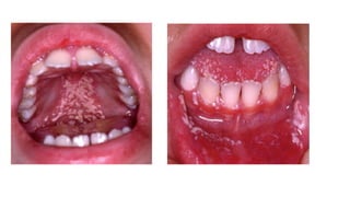 Pediatric soft tissue Oral lesions | PDF