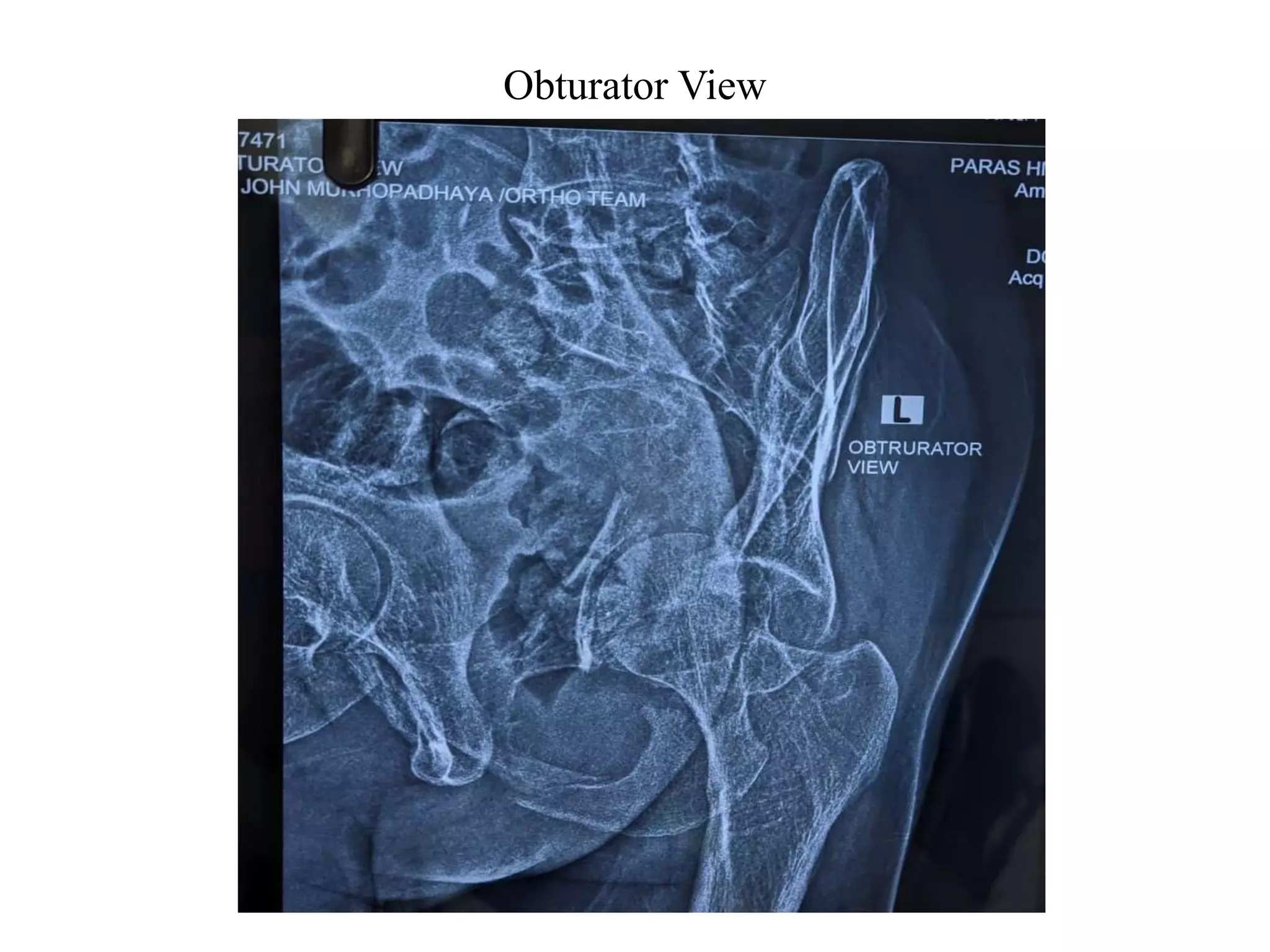Pelvis radiographs | PPTX