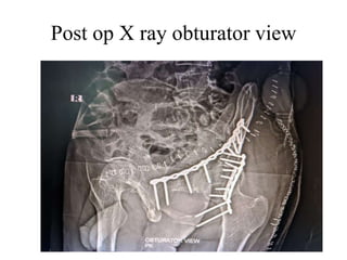 Pelvis radiographs | PPT
