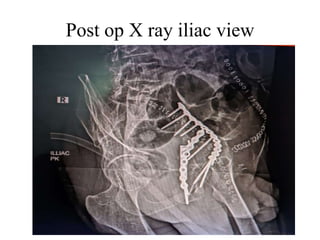 Pelvis radiographs | PPT