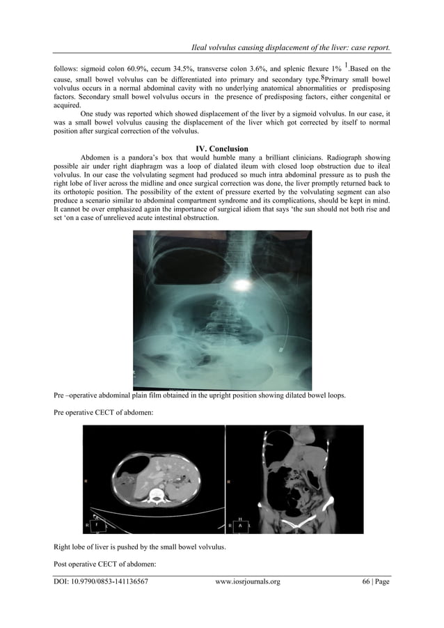 Ileal Volvulus Causing Displacement Of The Liver Case Report Pdf