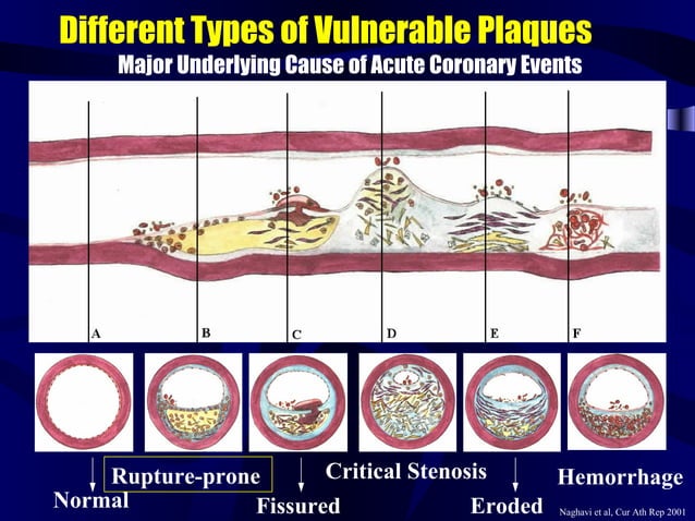 Tct recognition of vulnerable plaque guidelines | PPT