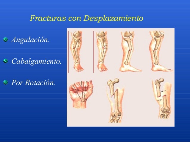 N4. Generalidades de Fractura