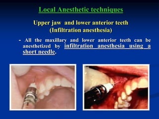 local anesthesia for dental child patient | PPT