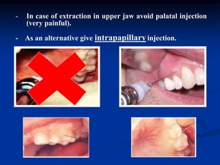 local anesthesia for dental child patient | PPT