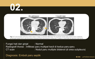 Septic Pulmonary Embolism Associated with Periodontal Disease: A case ...