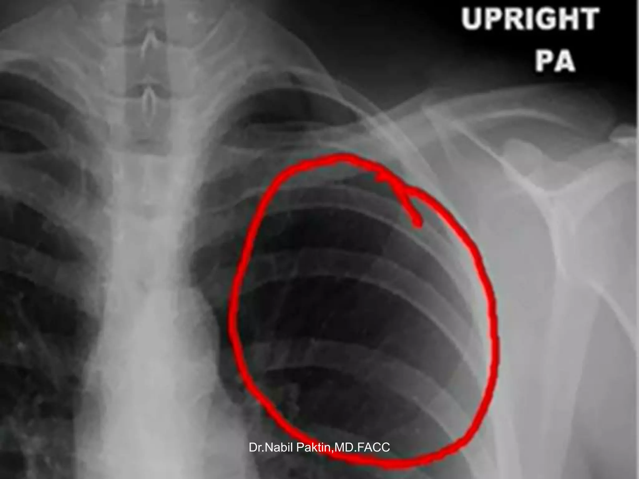 Chest-X ray , How to read a CXR | PPSX