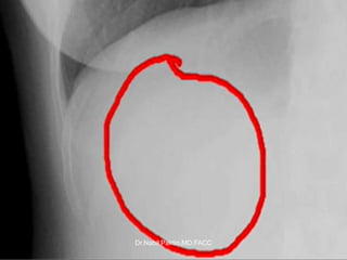 Chest-X ray , How to read a CXR | PPSX
