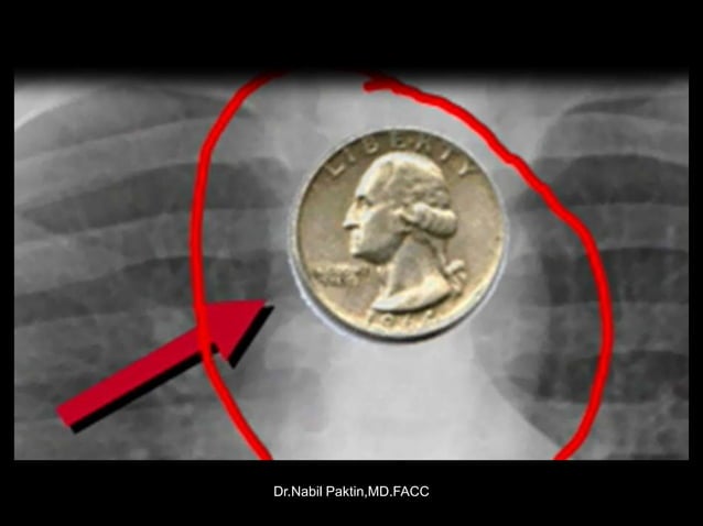 Chest-X ray , How to read a CXR | PPSX | Lung and Respiratory Health ...