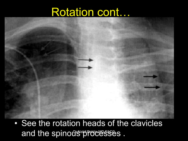 Chest-X ray , How to read a CXR | PPSX | Lung and Respiratory Health ...