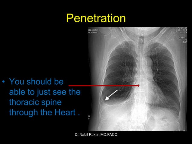 Chest-X ray , How to read a CXR | PPSX | Lung and Respiratory Health ...