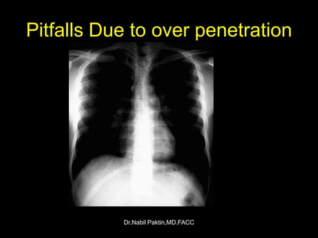 Chest-X ray , How to read a CXR | PPSX | Lung and Respiratory Health ...