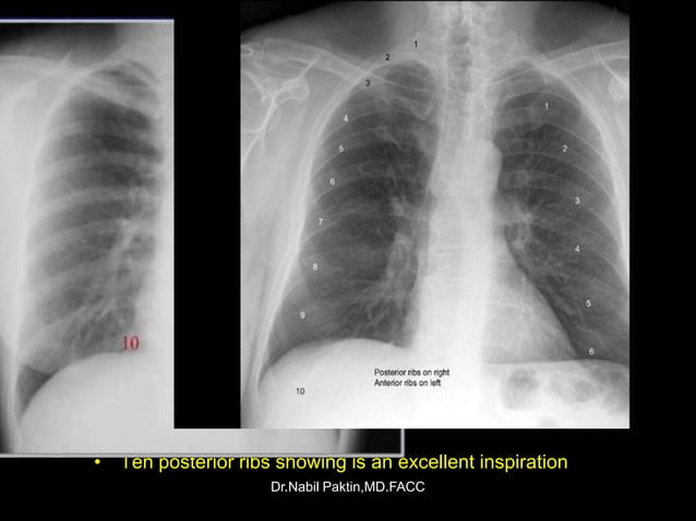 Chest-X ray , How to read a CXR | PPSX | Lung and Respiratory Health ...